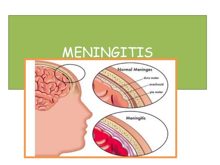MENINGITIS - Mind Map