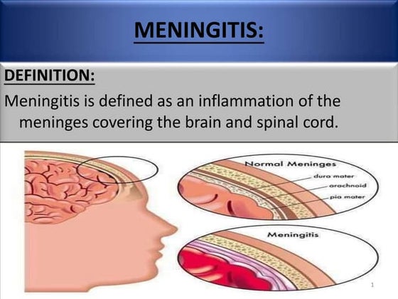 Meningitis | PPT