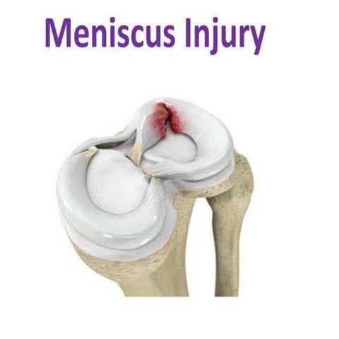 Meniscus injury after acute traumatic bleeding in brain | PPTX