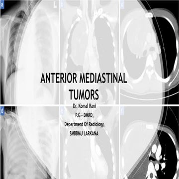 Anterior Mediastinal masses Presentation.PPT