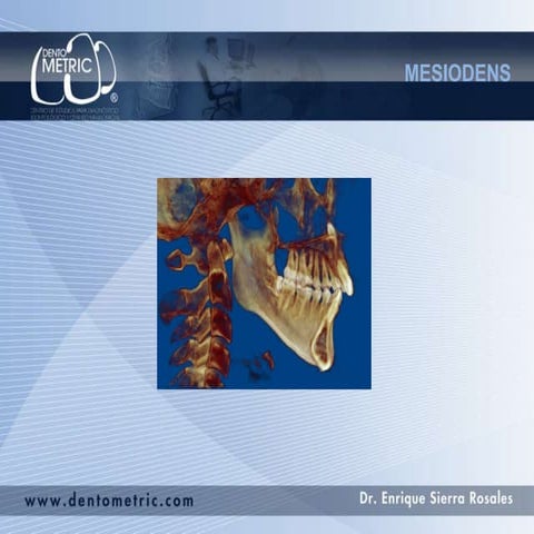 Mesiodens | PPTX