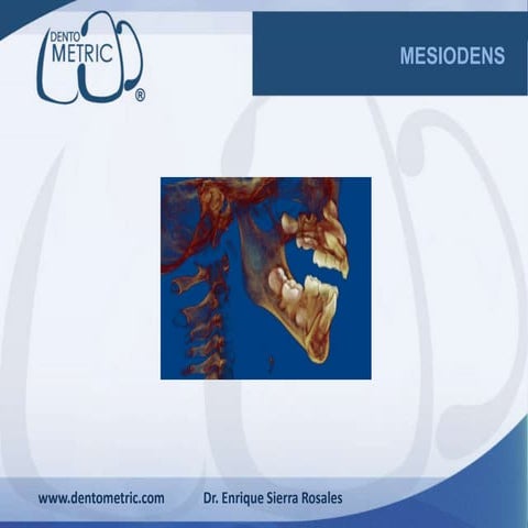 Mesiodens | PPTX