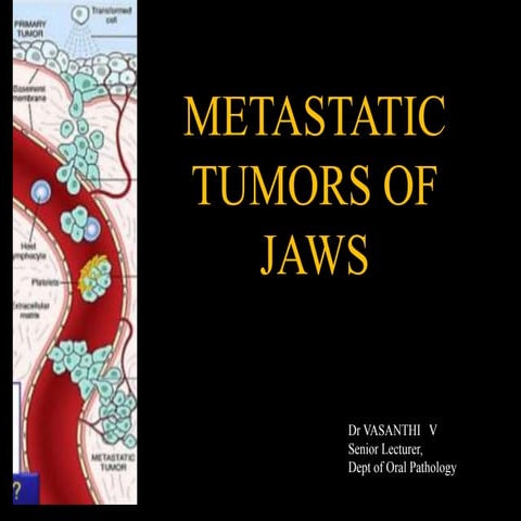 Metastatic tumors of jaws | PPTX