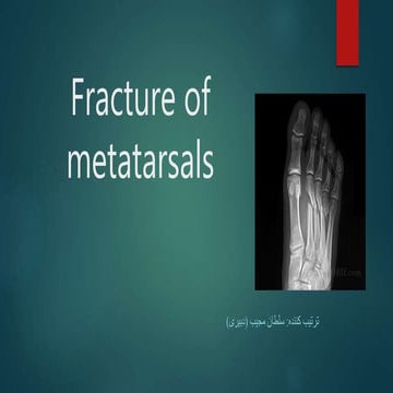 Metatarsal Fracture | PPTX