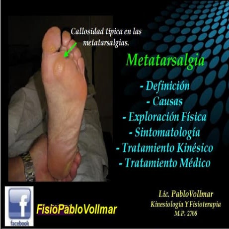 metatarsalgia fisioterapia pablo vollmar.PDF
