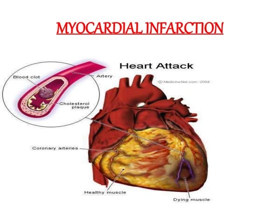MYOCARDIAL INFARCTION-MANAGEMENT | PPT