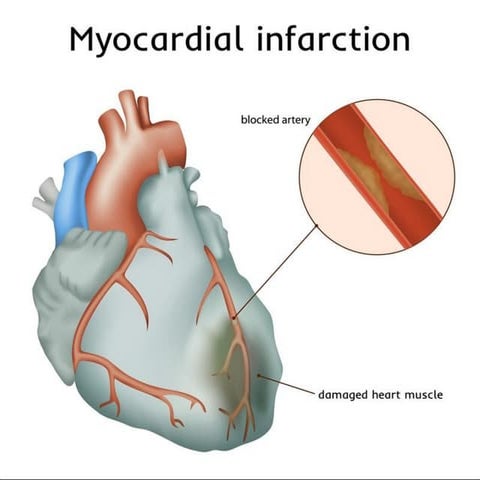 Comprehensive Case Study and Pathogenesis of Acute STEMI in a Diabetic ...