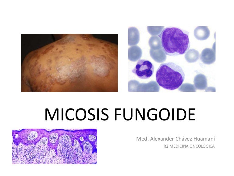 Micosis fungoide