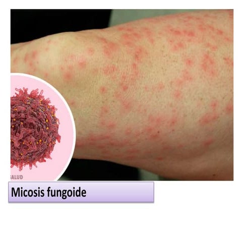 Micosis fungoide | PPTX