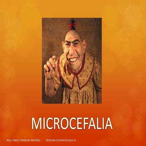 Microcefalia | PPTX