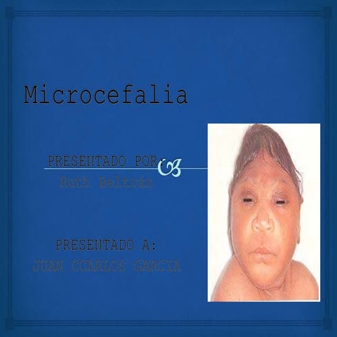 Microcefalia | PPTX