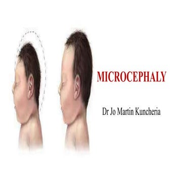 MICROCEPHALY jo.pptx