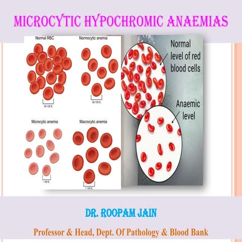 Microcytic Hypochromic Anaemias, Iron Deficiency Anaemia | PPTX