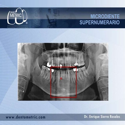Microdiente supernumerario | PPTX