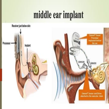 middle ear implant.pptx