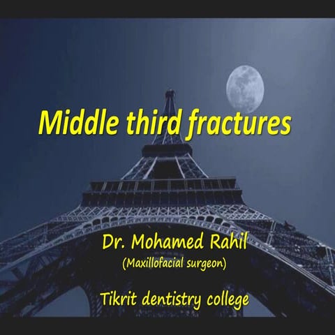 Middle third fractures | PPSX