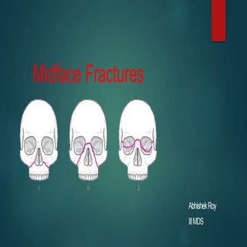 Midface fractures | PPTX