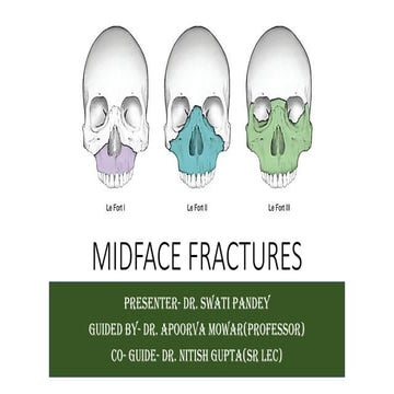 MIDFACE FRACTURES omfs mds final123.pptx