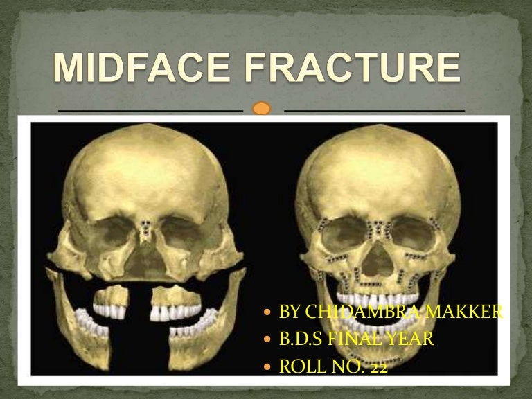 Midfacial fractures - oral surgery b.d.s