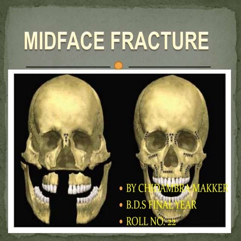 Midfacial fractures - oral surgery b.d.s | PPTX