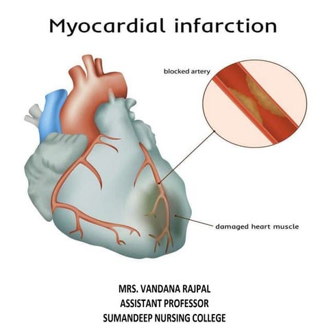 Myocardial Infarction | PPTX