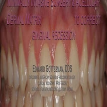 Gingival recession classifications | PPTX