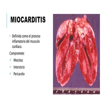 Miocarditis: causas, síntomas y tratamiento | PPT