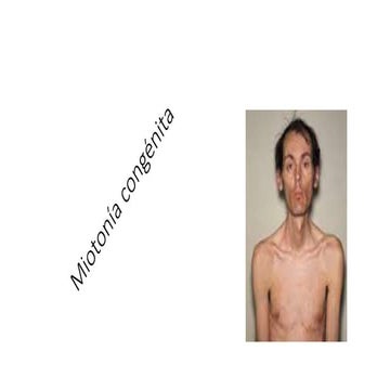 Miotonía congénita | PPTX