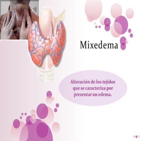 Mixedema | PPTX