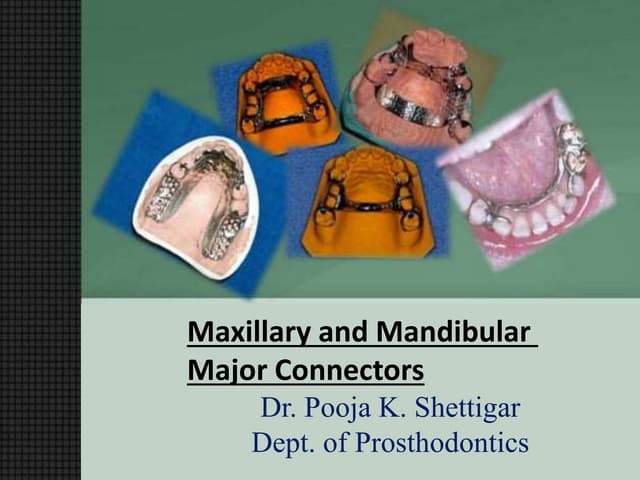 Maxillary major connectors | PPTX
