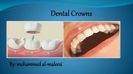 Different gingival finish lines (margins) of crowns and bridges | PPTX