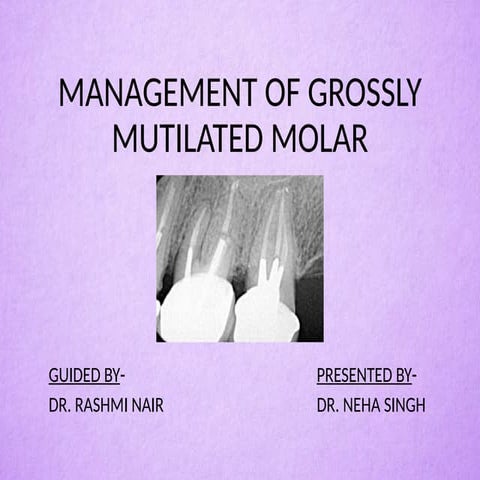 mngmnt of grossly mutilated molar - final.pptx