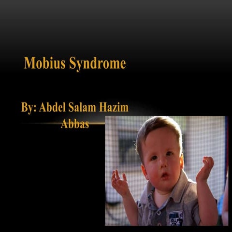 Mobius syndrome 2018 | PPTX