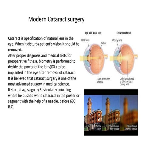 Modern cataract surgery | PPTX