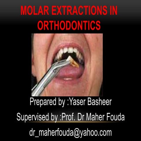 Molar extractions in orthodontics | PPTX