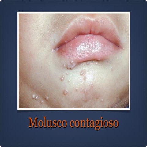 Molusco contagioso: causas, síntomas y tratamientos efectivos | PPT