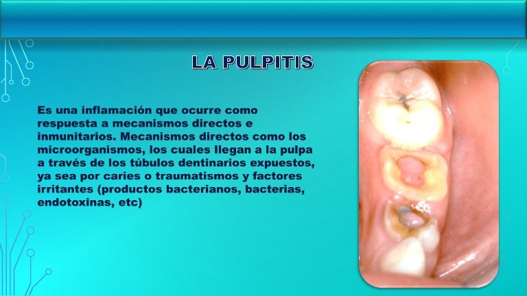 Monografia pulpitis