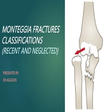 MONTEGGIA FRACTURES CLASSIFICATIONS.pptx