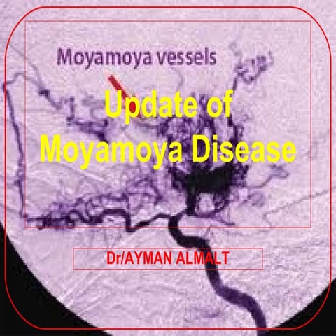 Moyamoya disease | PPT