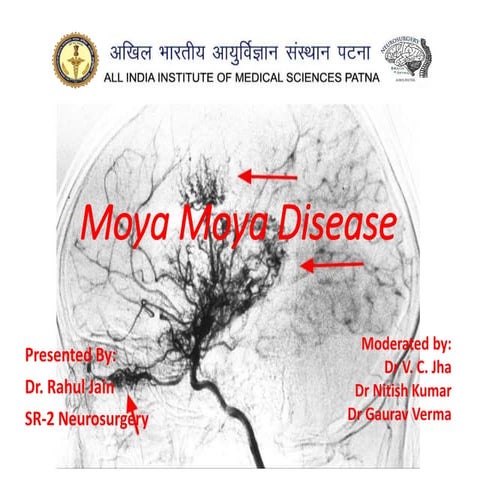 Moya Moya disease (vasculopathy/angiopathy) | PPTX