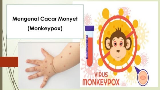 penyakit tentang monkey pox dan cara pencegahannya | PPT