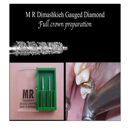 Full crown preparation using M R Dimashkieh self limiting bur | PDF