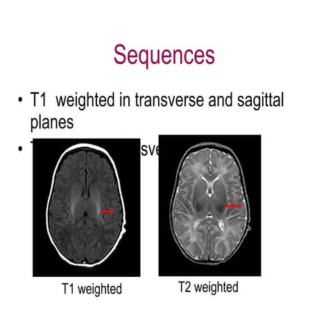 Mri neonatal brain 1 | PPT