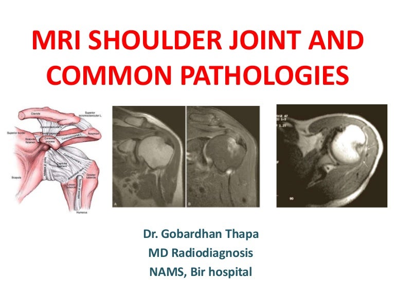 Mri shoulder joint with common pathologies