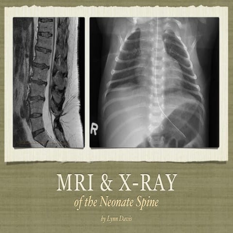 MRI and X-Ray of the Neonate Spine | PDF