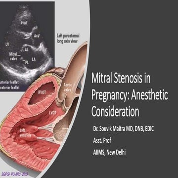 Mitral Stenosis | PPTX