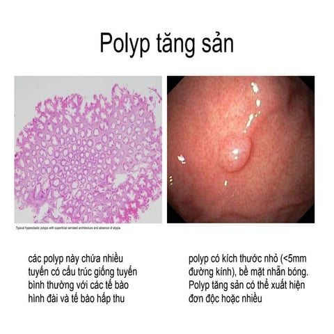 hinh anh vi the polyp hinh anh vi the polyp | PPTX