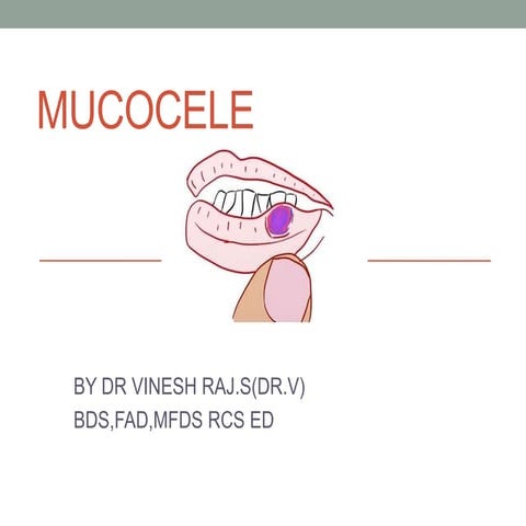Mucocele | PPTX