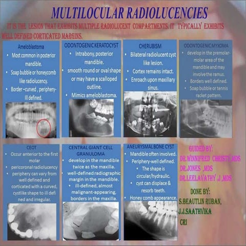 Multilocular radiolucencies | PPTX