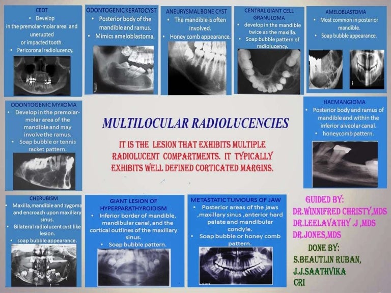 Multilocular radiolucencies modified1